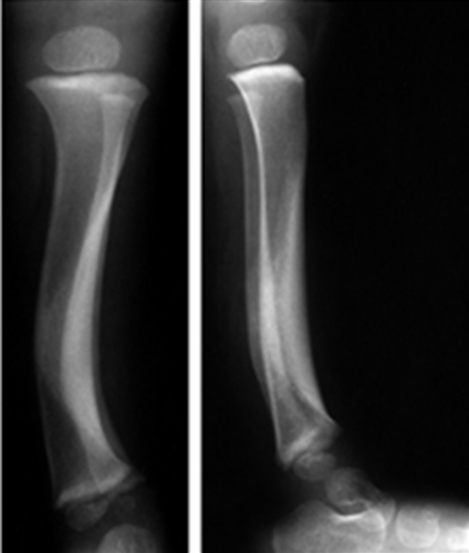 Posteromedial Tibial Bowing : 네이버 블로그